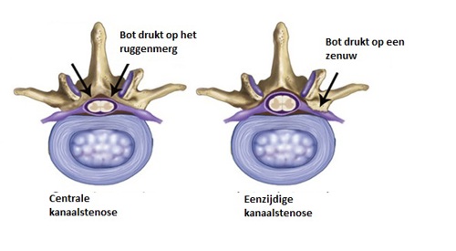 Hernia - Operatie bij hernia / kanaalstenose